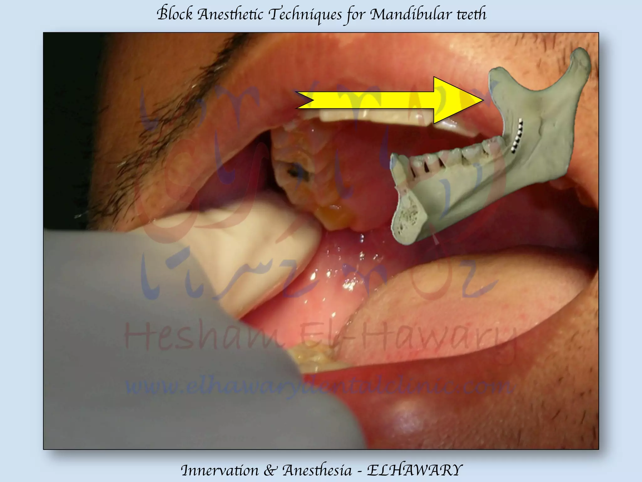 Mandibular teeth anesthetic block techniques | PDF