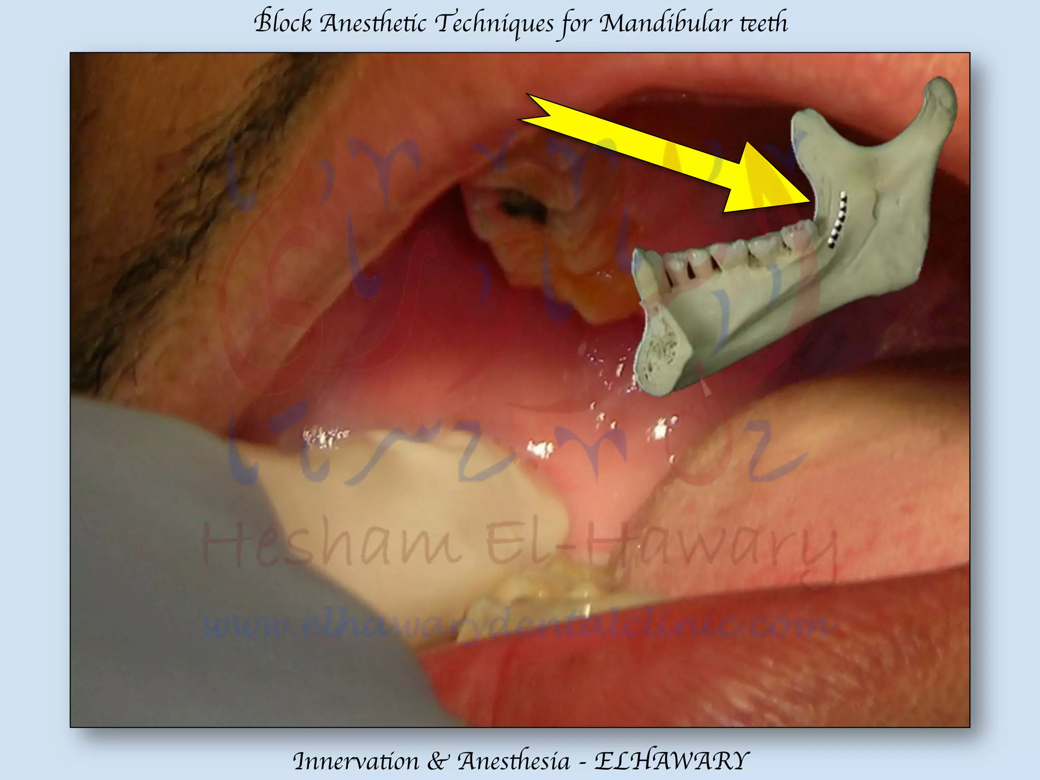 Mandibular teeth anesthetic block techniques | PDF