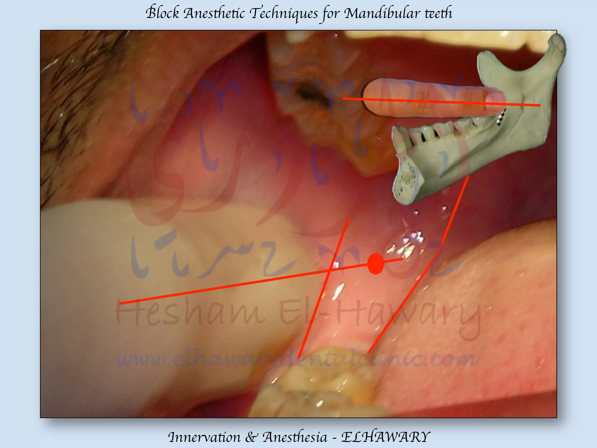 Mandibular teeth anesthetic block techniques | PDF