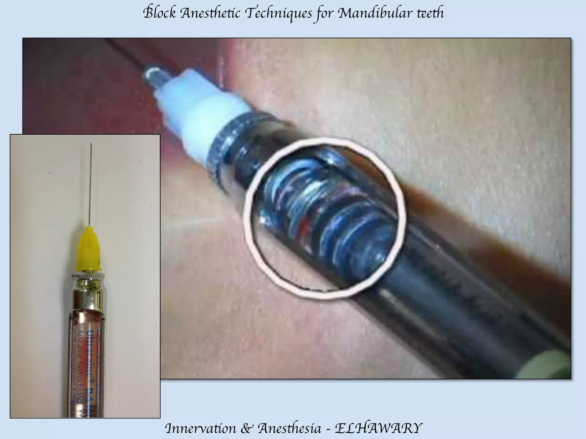 Mandibular teeth anesthetic block techniques | PDF