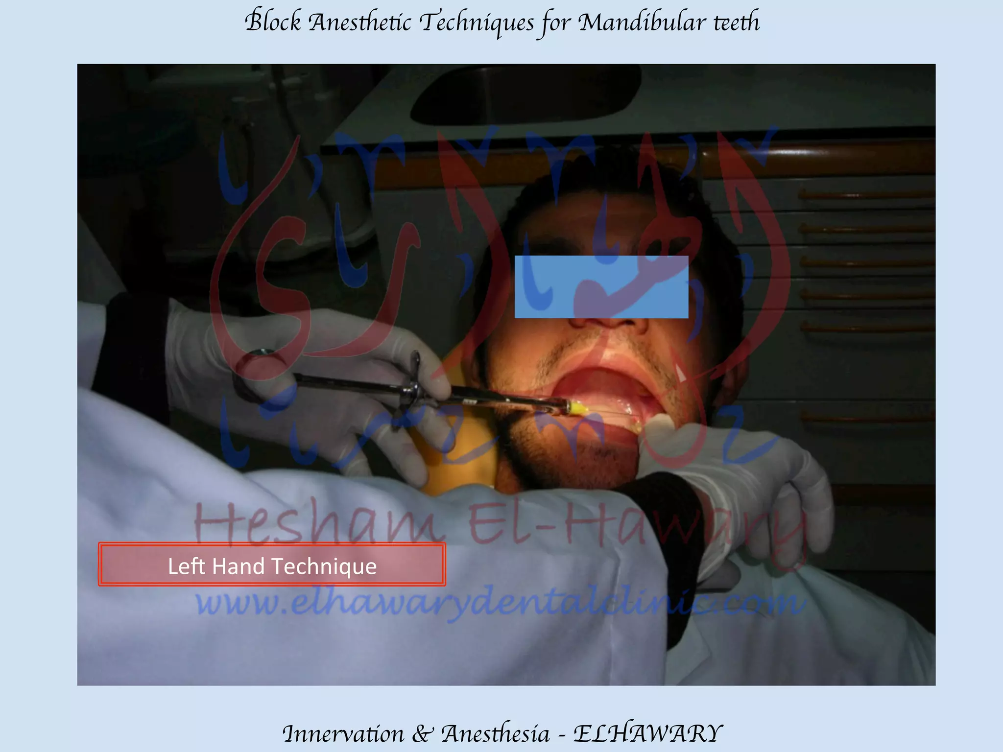Mandibular teeth anesthetic block techniques | PDF