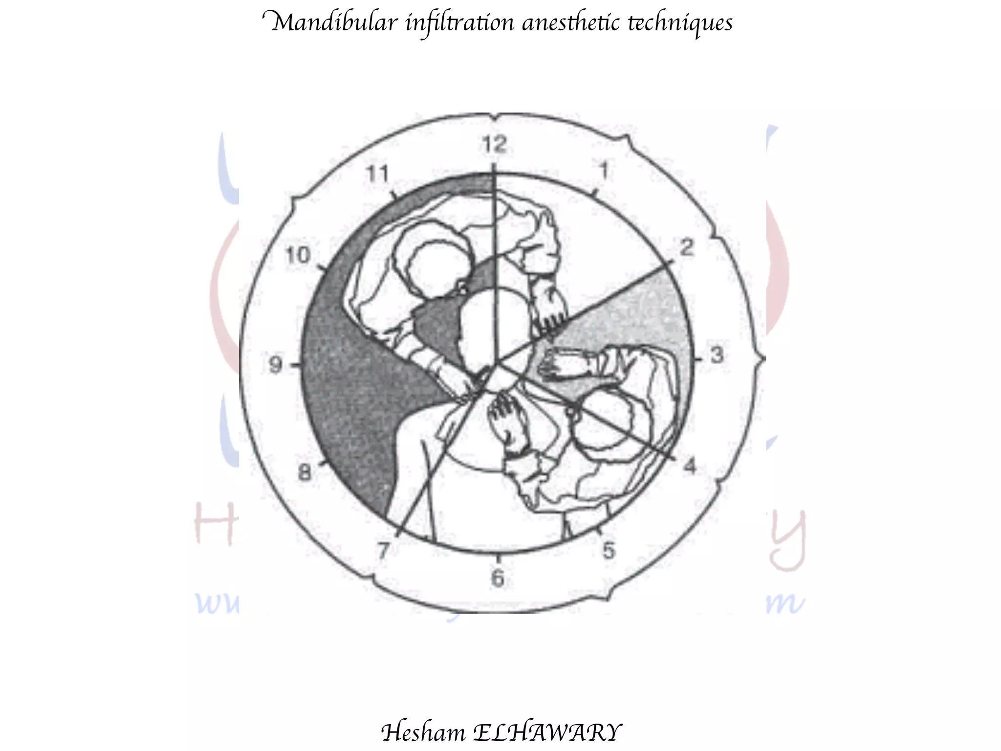 Mandibular teeth infilteration techniques | PDF