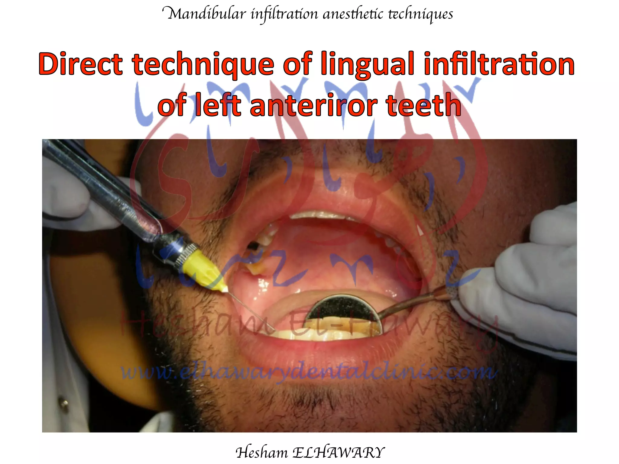 Mandibular teeth infilteration techniques | PDF