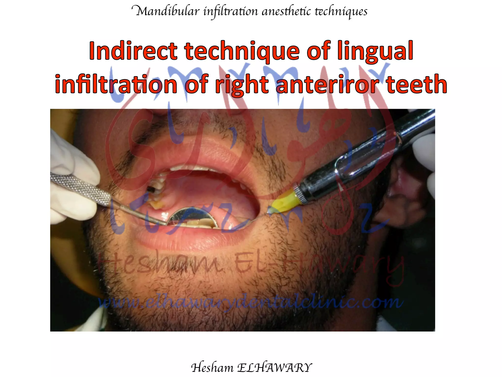 Mandibular teeth infilteration techniques | PDF