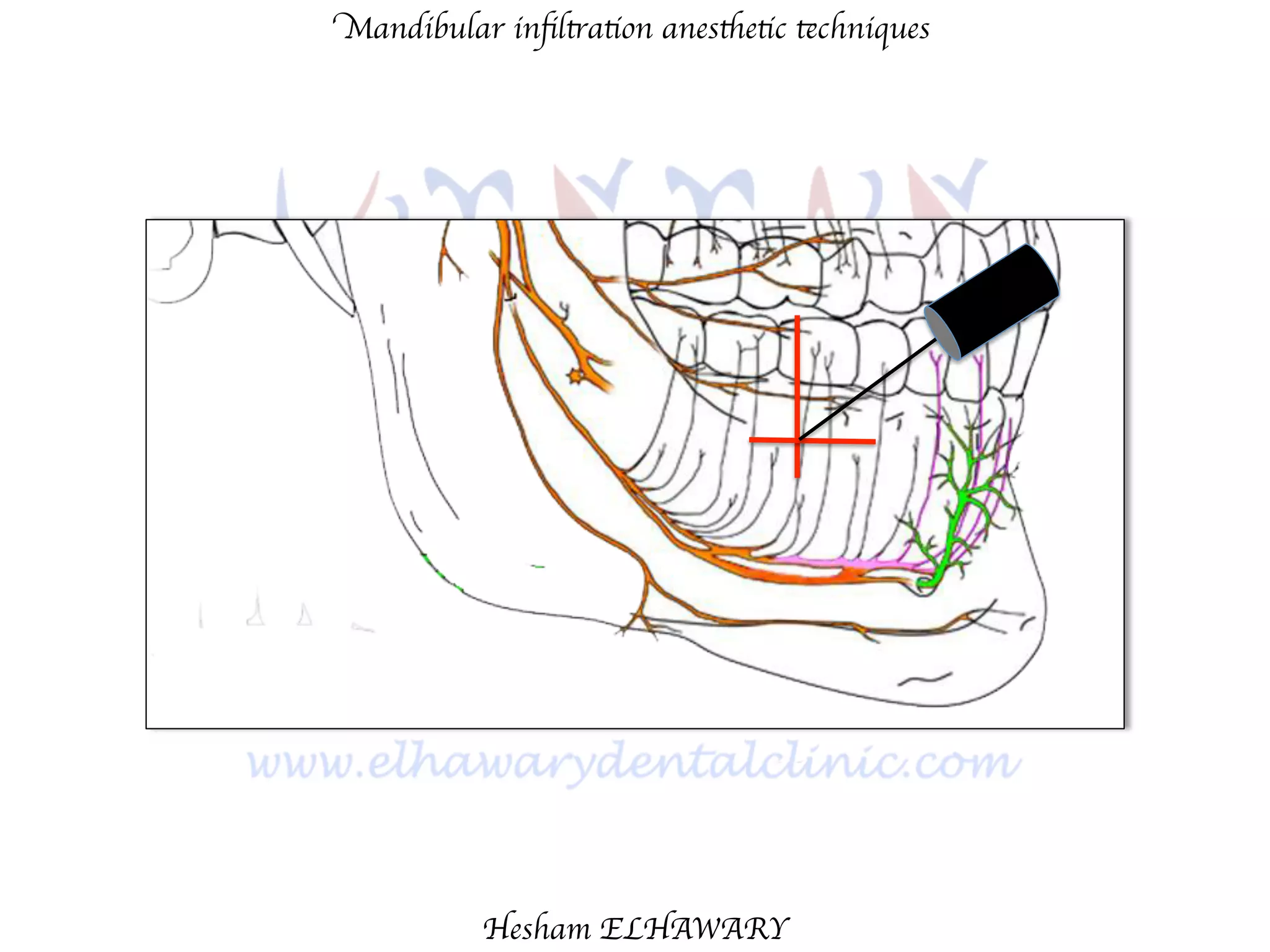Mandibular teeth infilteration techniques | PDF