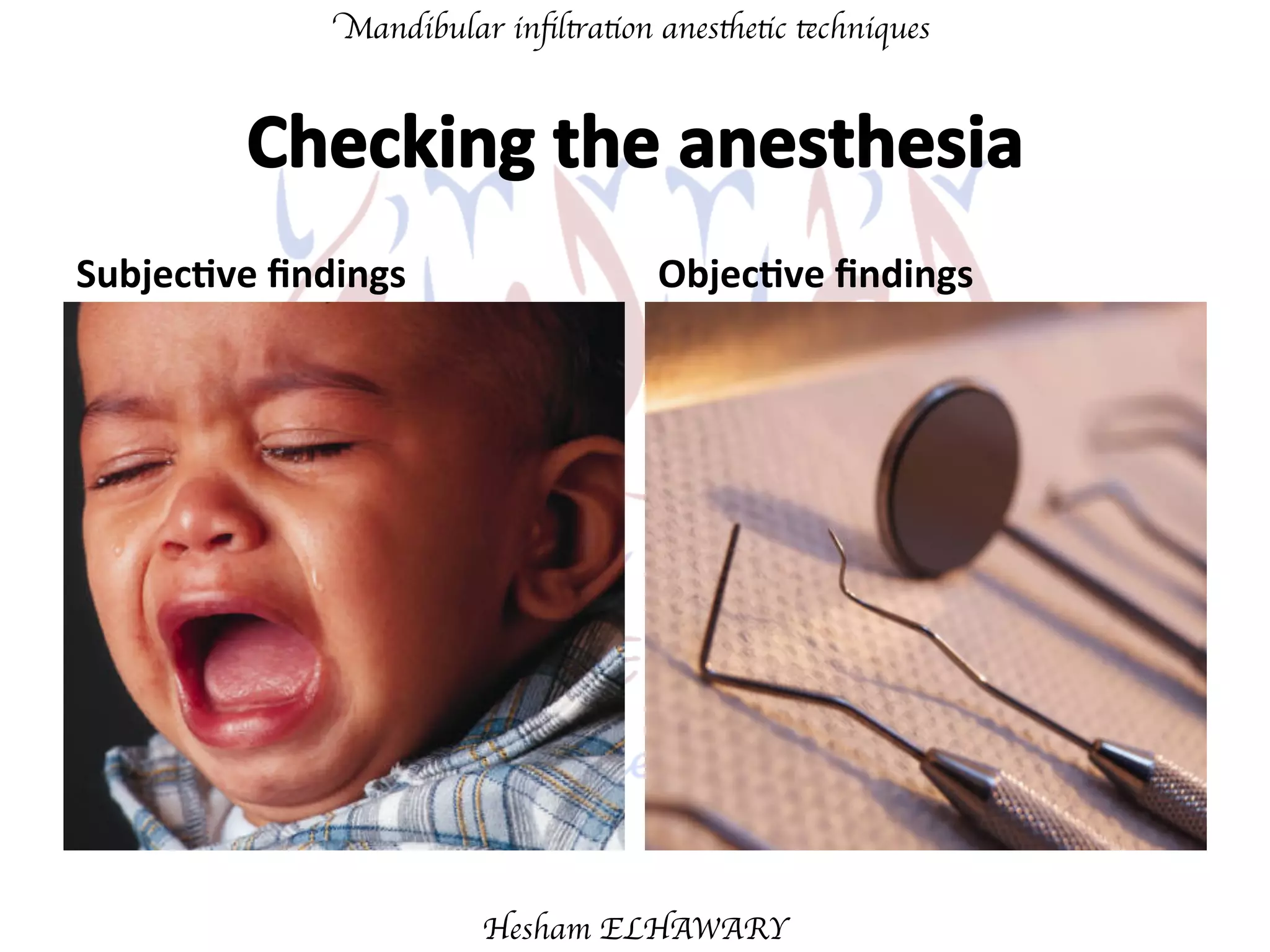 Mandibular teeth infilteration techniques | PDF