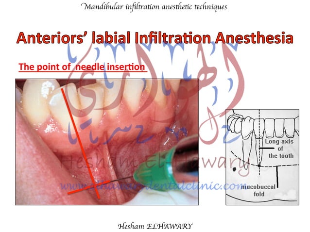 Mandibular teeth infilteration techniques | PDF
