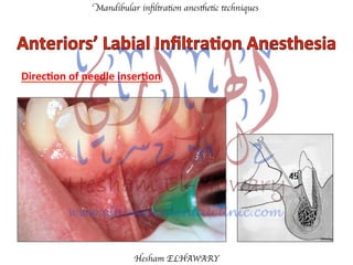 Mandibular teeth infilteration techniques | PPT