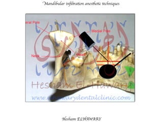 Mandibular teeth infilteration techniques | PPT