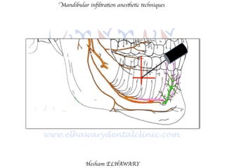 Mandibular teeth infilteration techniques | PPT