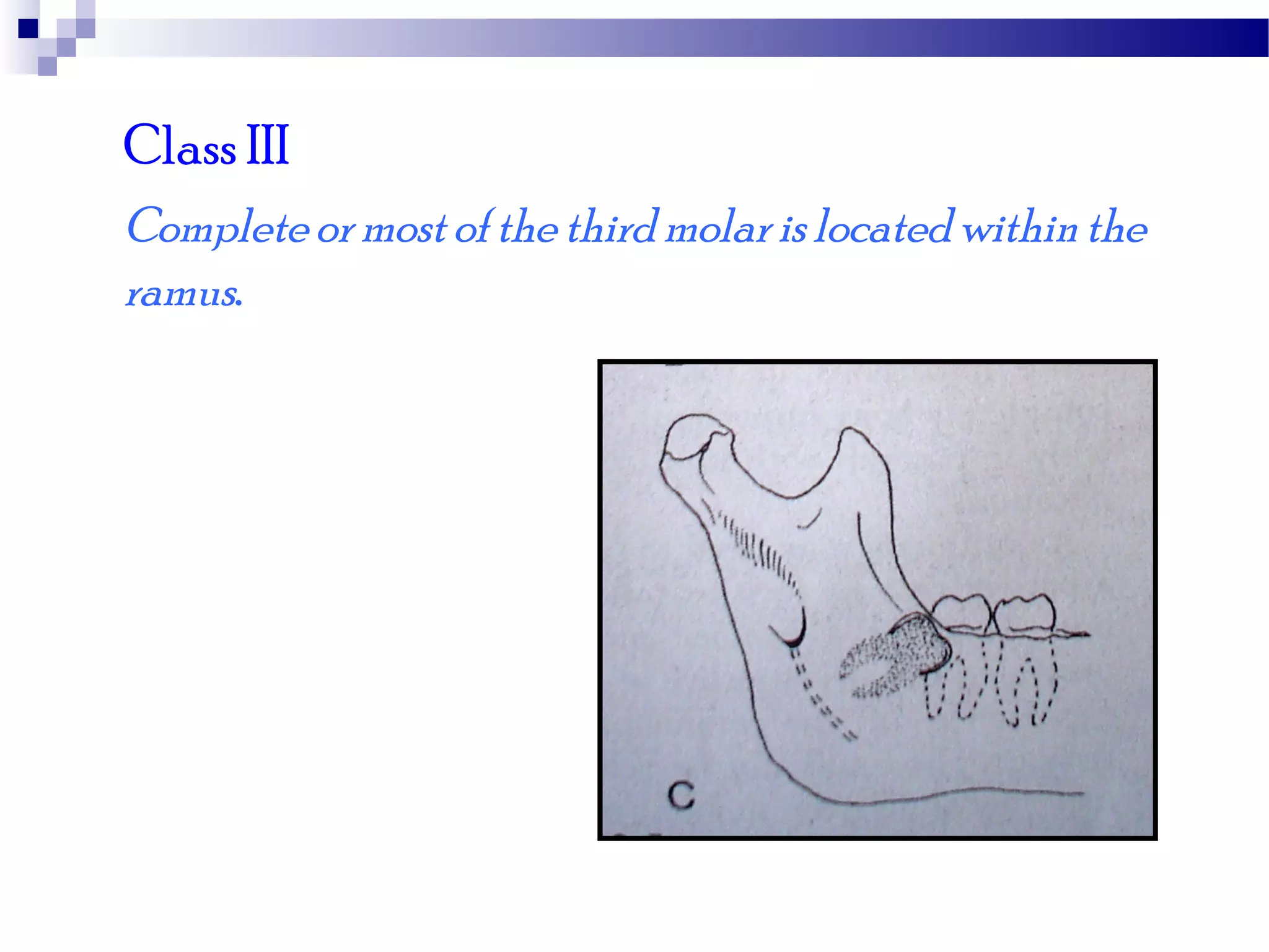 Mandibular third moalr impaction | PPT