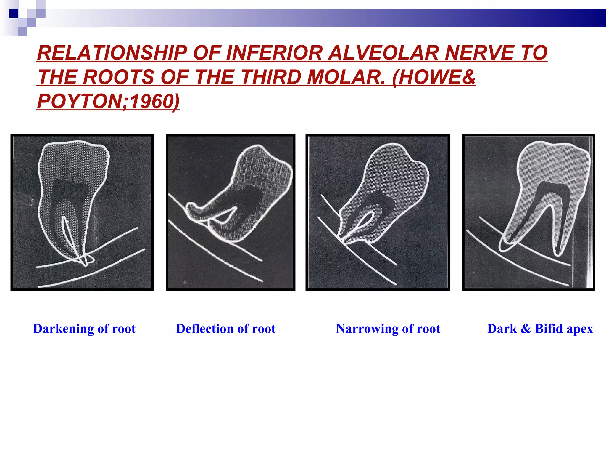 Mandibular third moalr impaction | PPT