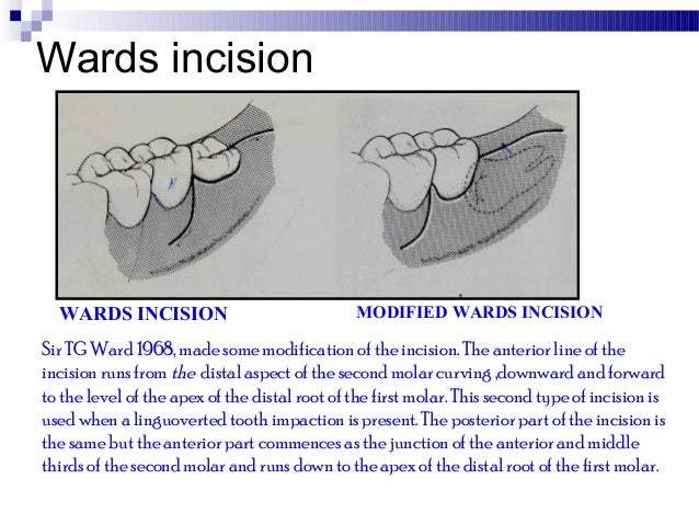 Mandibular third moalr impaction