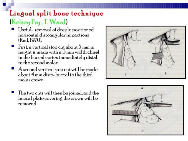 Mandibular third moalr impaction