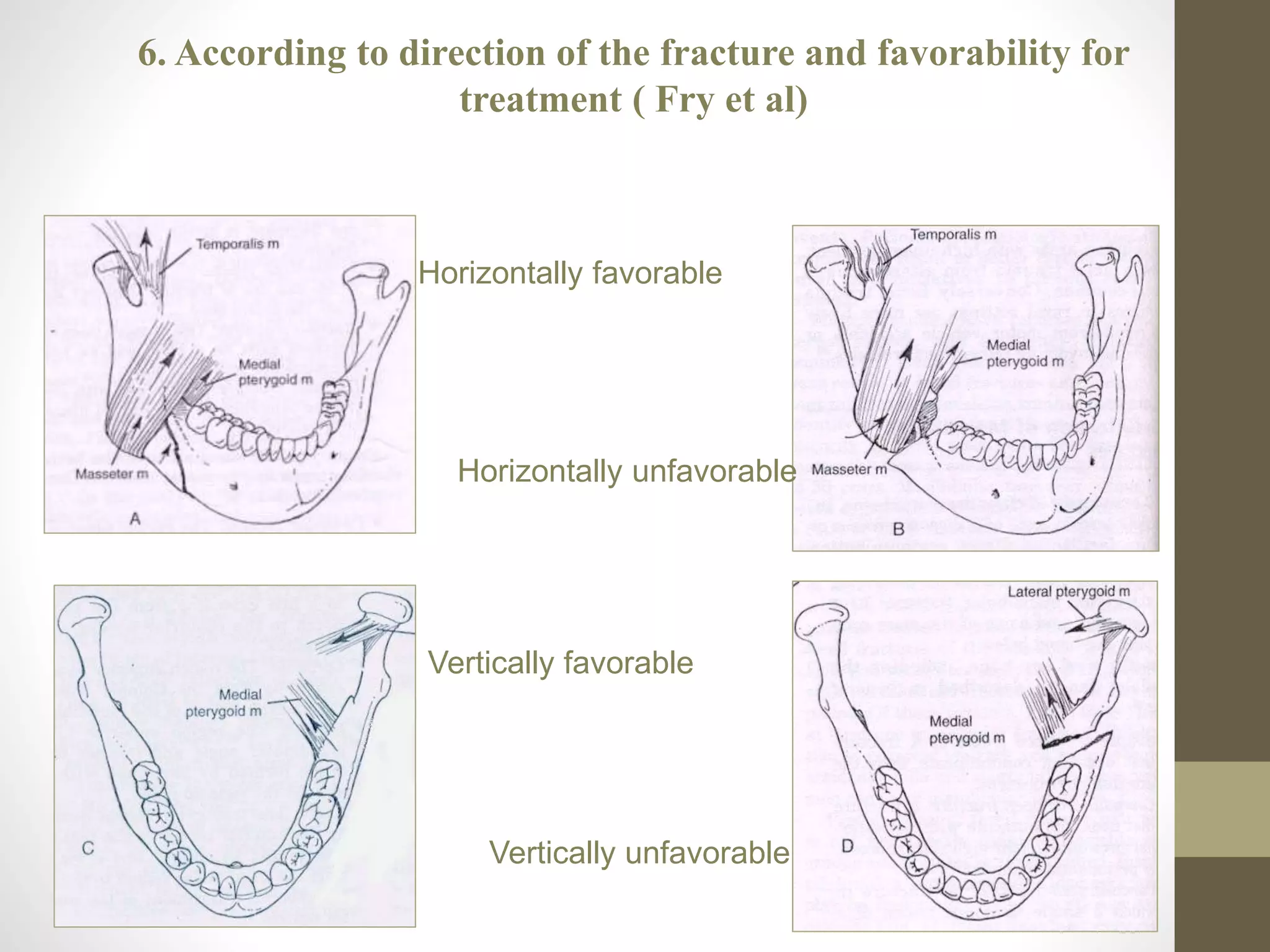 Mandibular trauma | PPTX