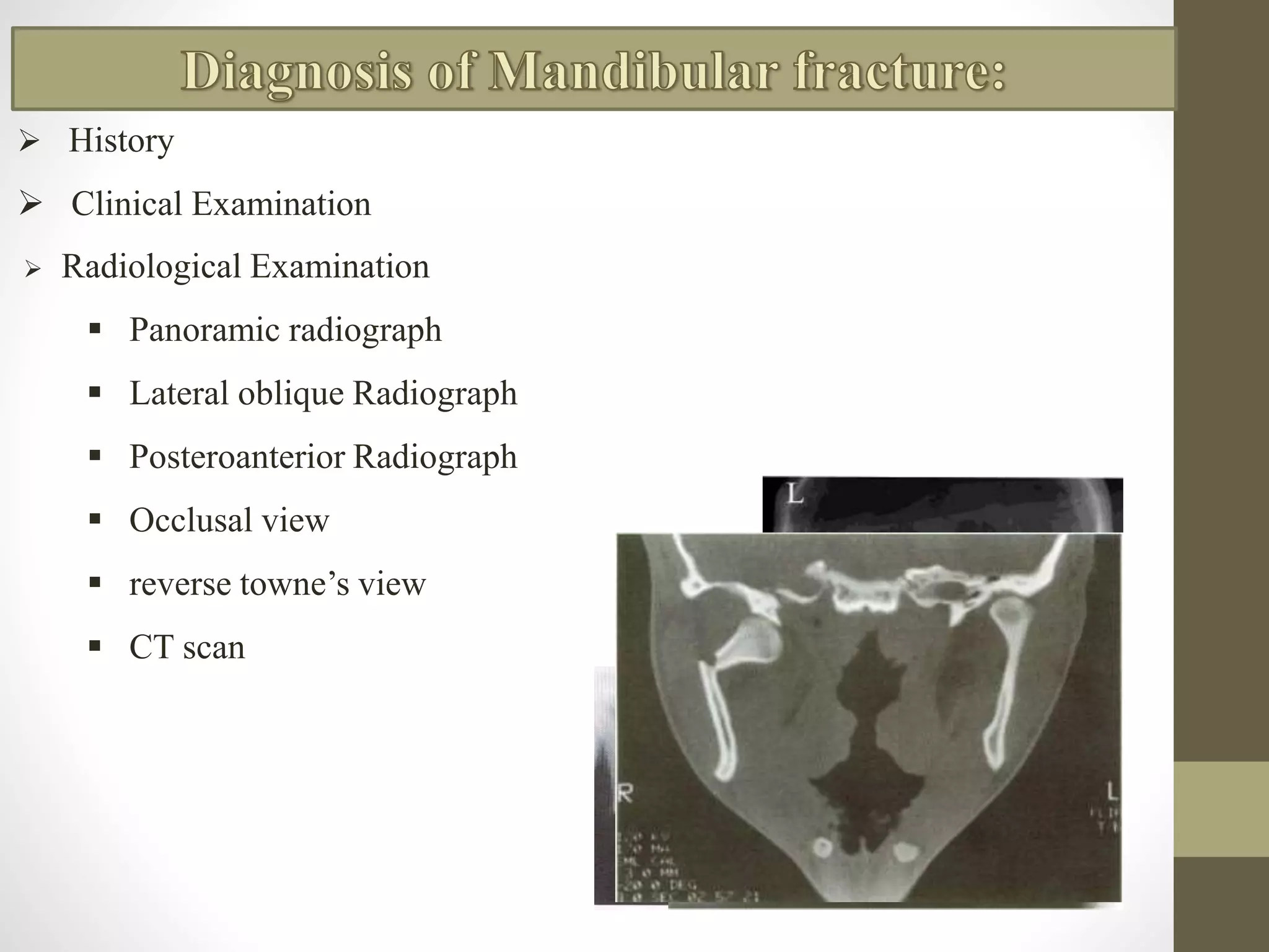 Mandibular trauma | PPTX