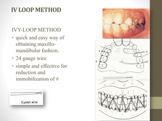 Mandibular trauma | PPTX
