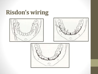 Mandibular trauma | PPTX