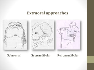 Mandibular trauma | PPTX