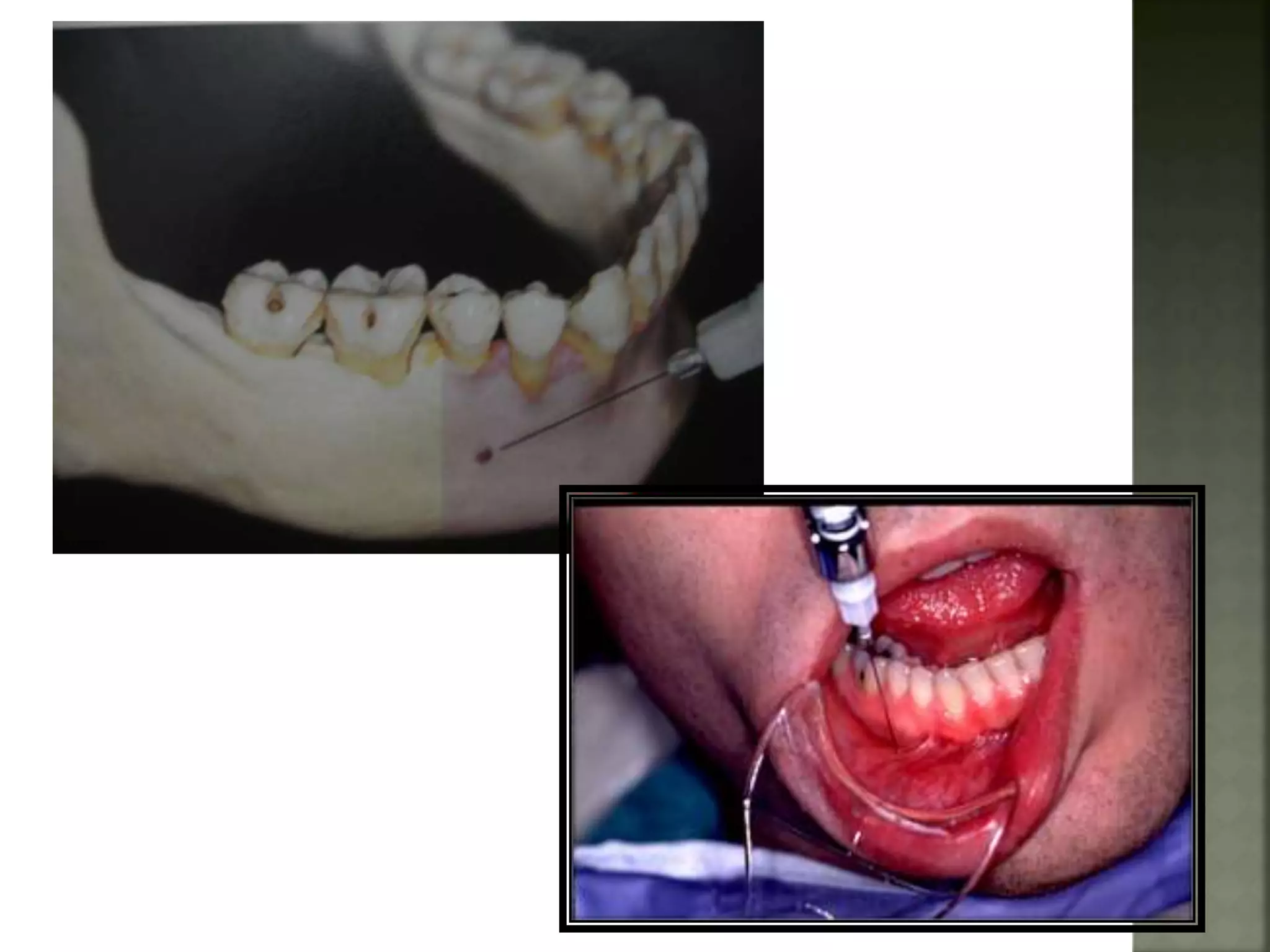 Mandibular nerve blocks techniques | PPTX | Ear, Nose and Throat ...