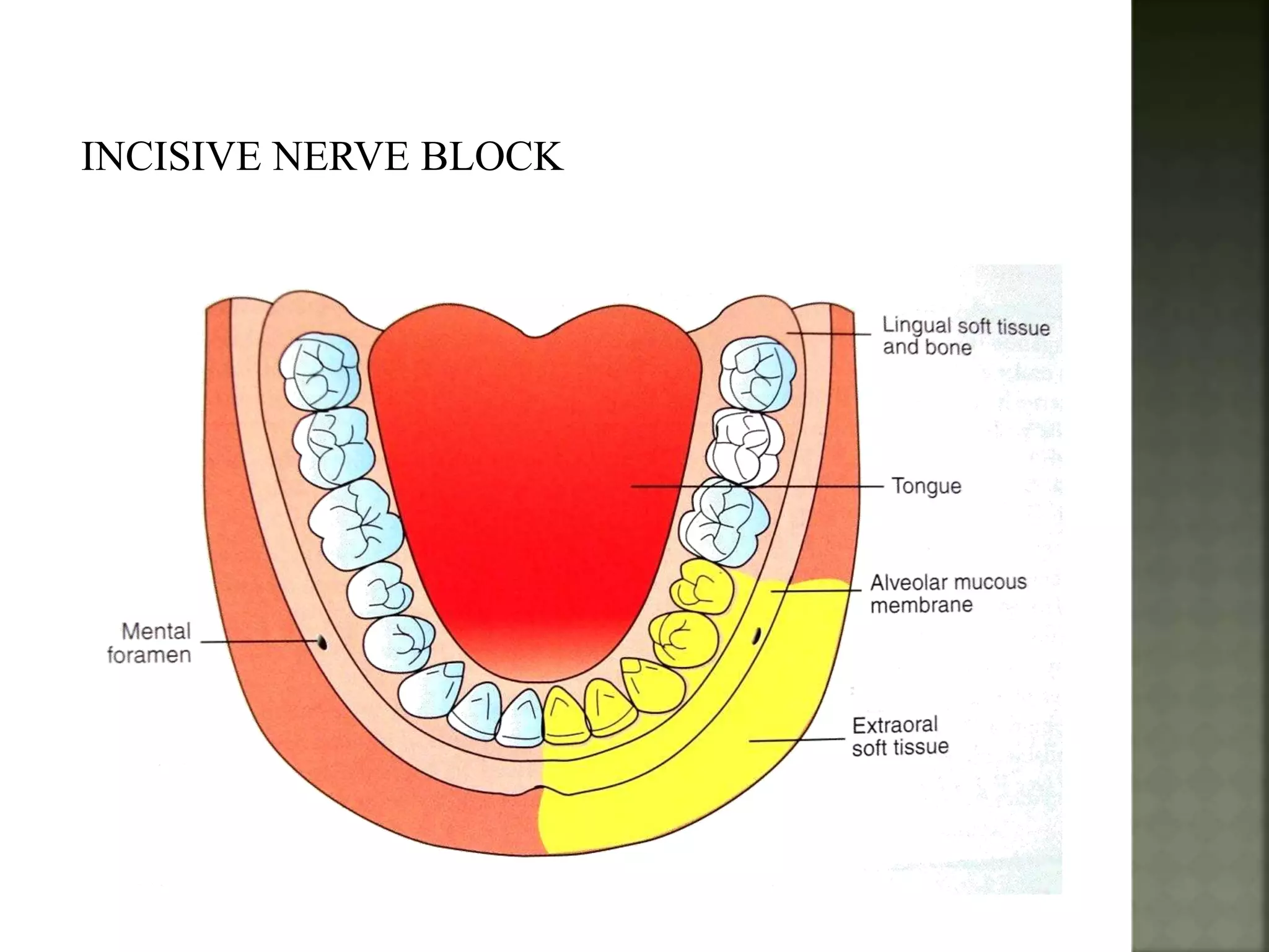 Mandibular nerve blocks techniques | PPTX | Ear, Nose and Throat ...