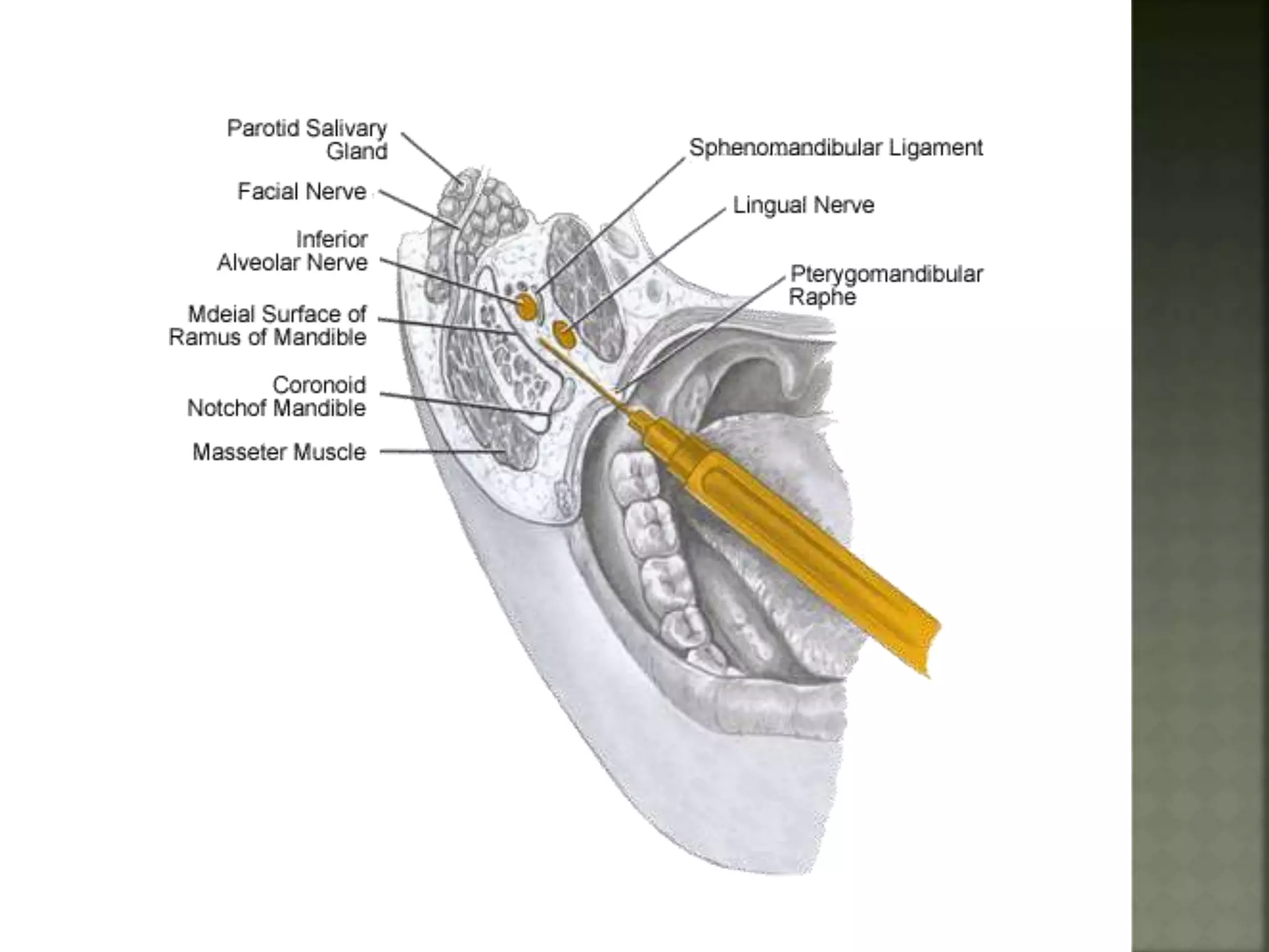 Mandibular nerve blocks techniques | PPTX | Ear, Nose and Throat ...