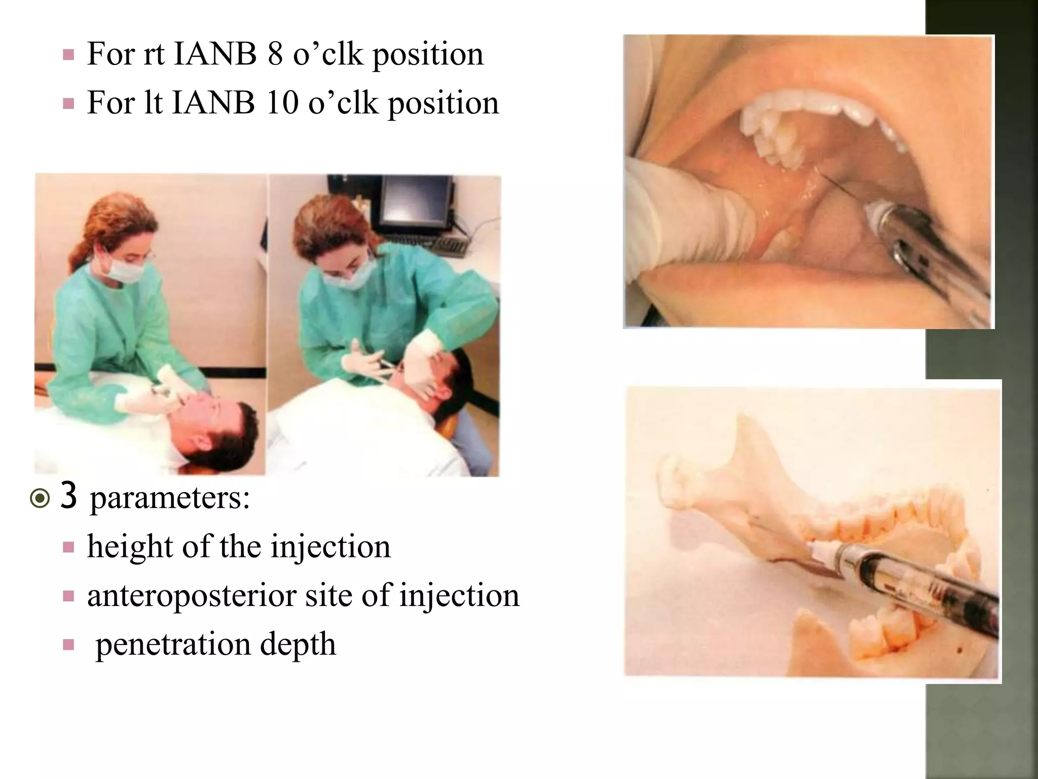 Mandibular nerve blocks techniques | PPTX