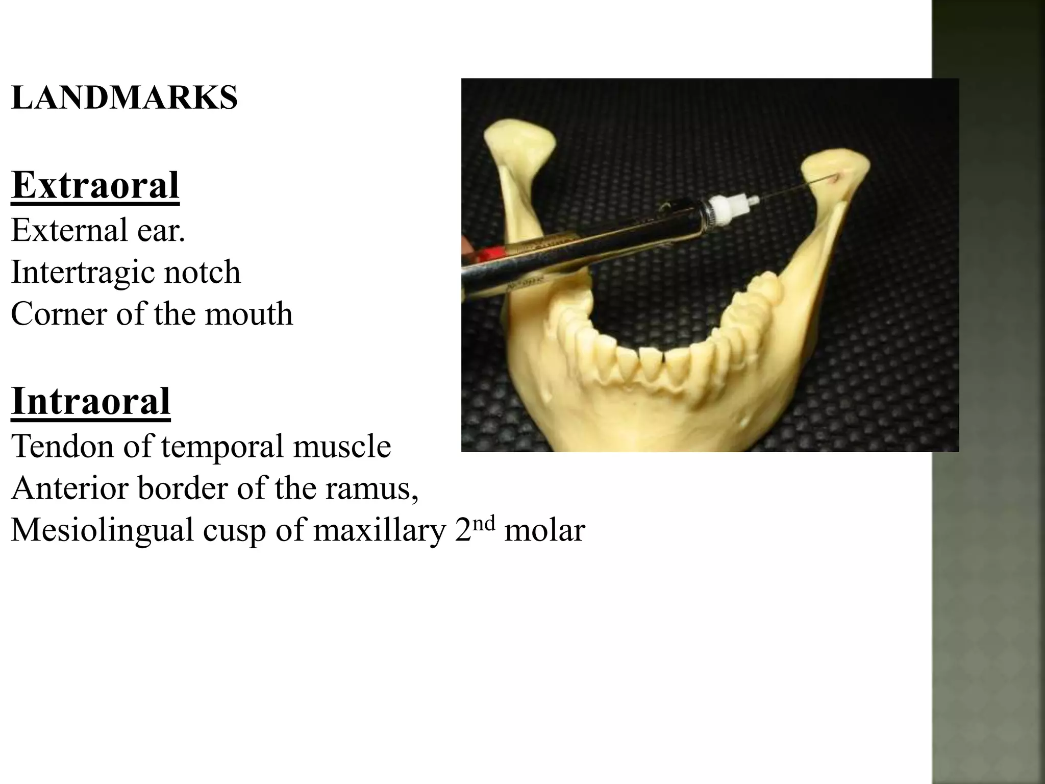 Mandibular nerve blocks techniques | PPTX