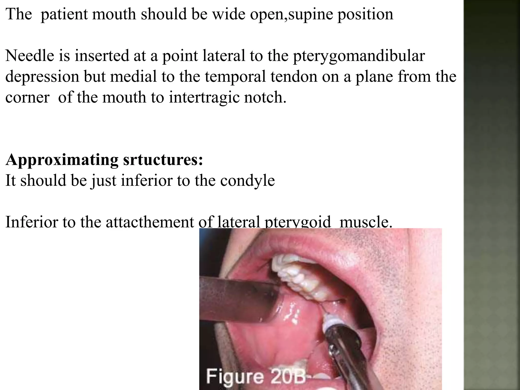 Mandibular nerve blocks techniques | PPTX | Ear, Nose and Throat ...