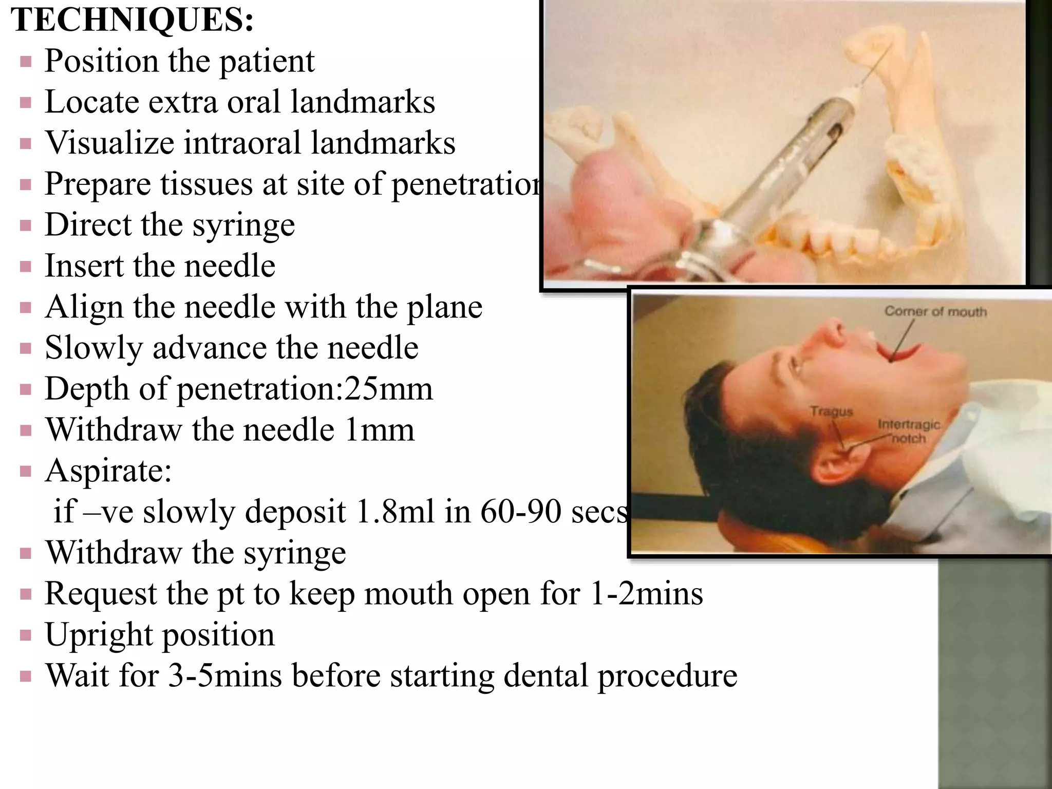 Mandibular nerve blocks techniques | PPTX
