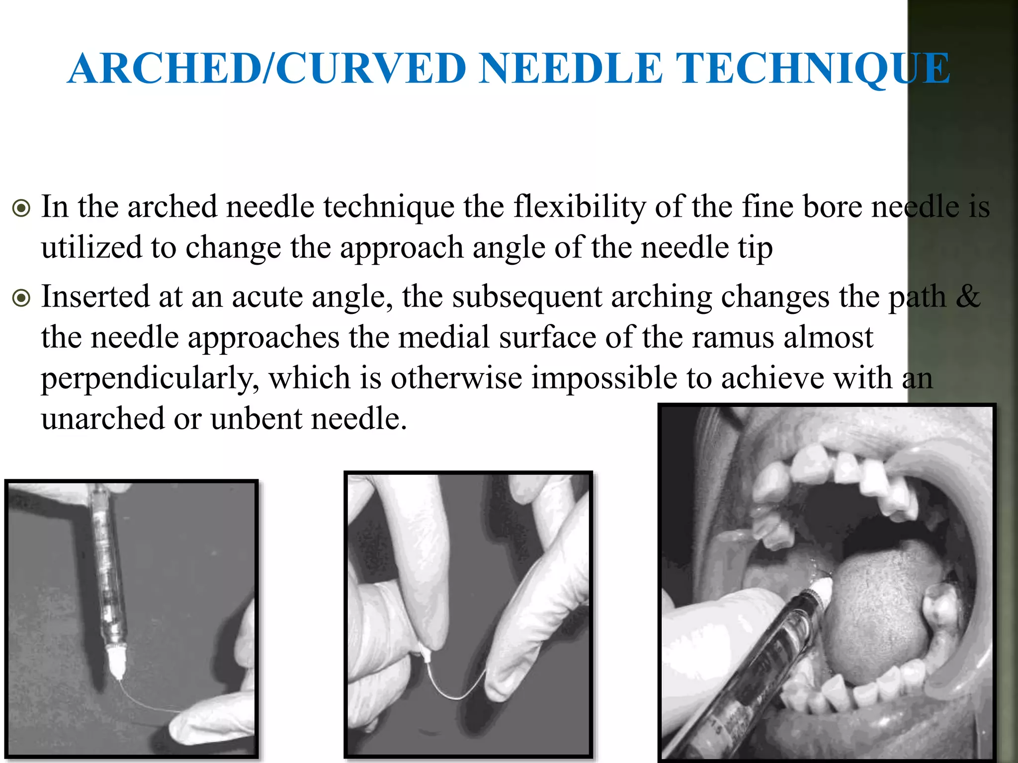 Mandibular nerve blocks techniques | PPTX