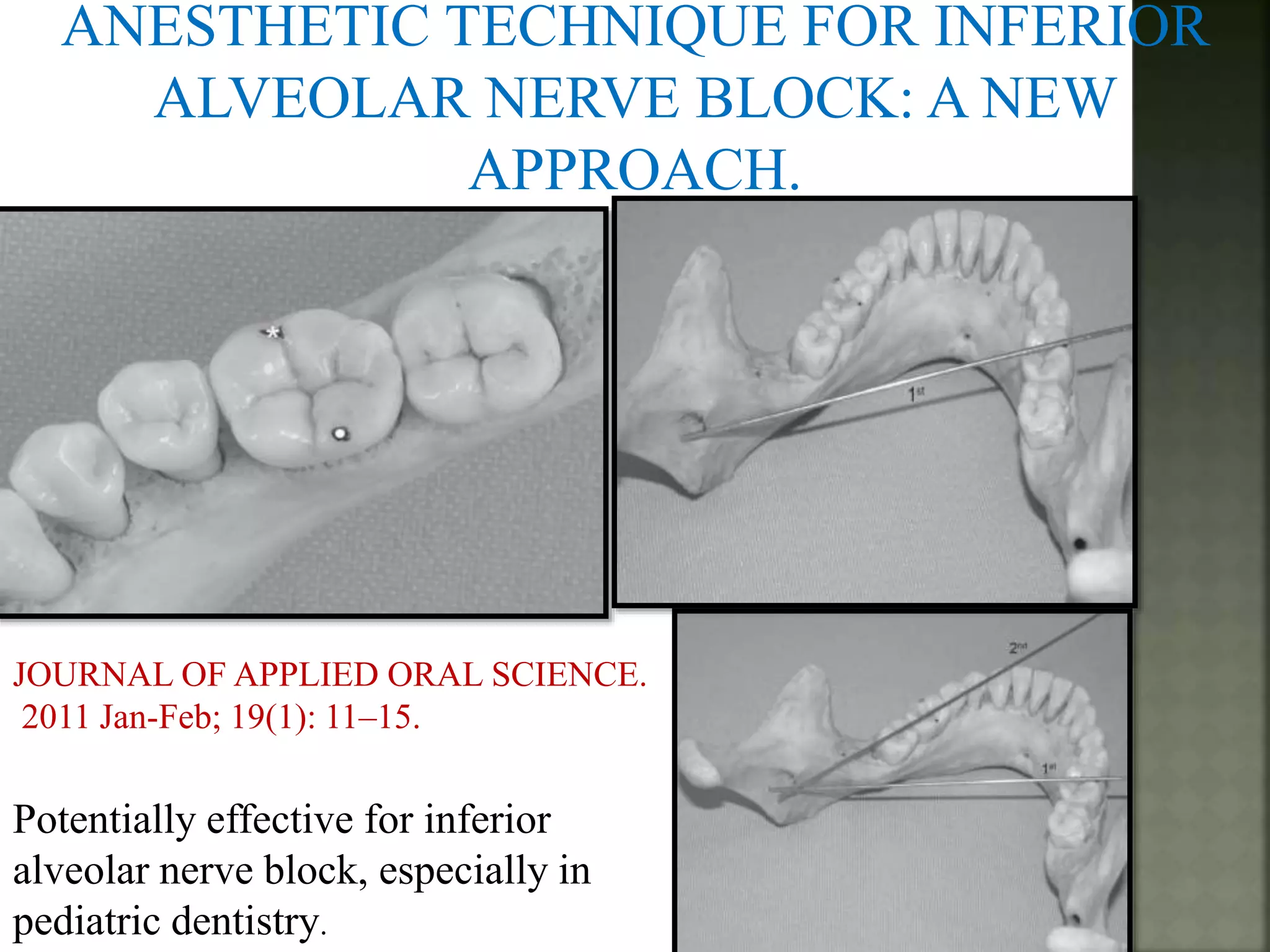 Mandibular nerve blocks techniques | PPTX
