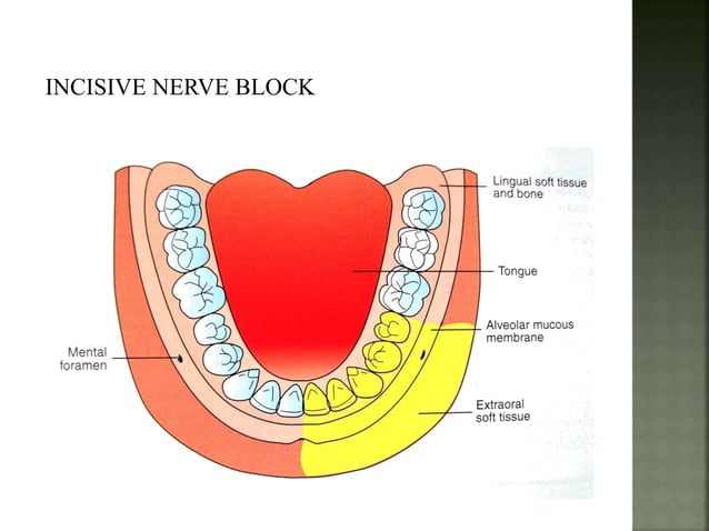Mandibular nerve blocks techniques | PPTX | Ear, Nose and Throat ...