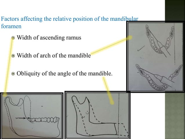 Mandibular nerve blocks techniques | PPTX | Ear, Nose and Throat ...