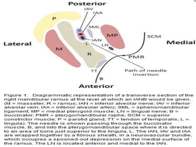 Mandibular nerve blocks techniques | PPTX | Ear, Nose and Throat ...