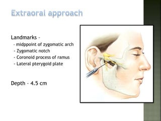 Auriculotemporal Nerve Block Ppt