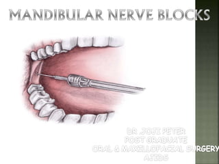 Buccal Nerve Block