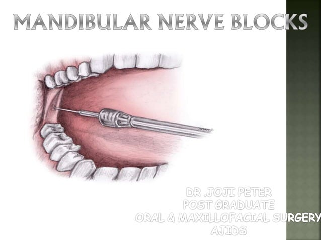 Mandibular nerve blocks techniques | PPT