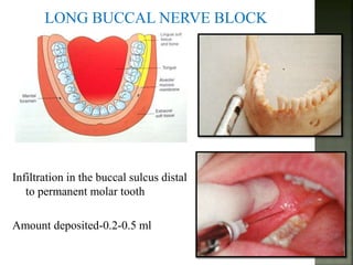Buccal Nerve Block