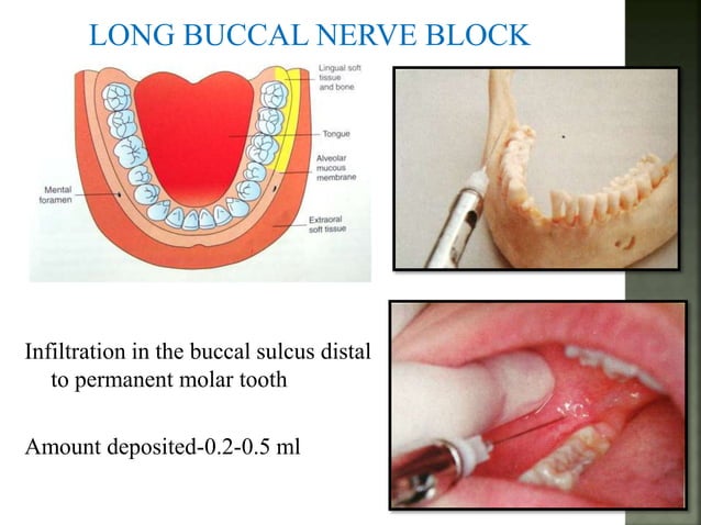 Mandibular nerve blocks techniques | PPT