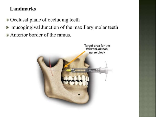 Mandibular nerve blocks techniques | PPT