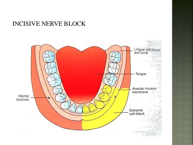 Mandibular nerve blocks techniques