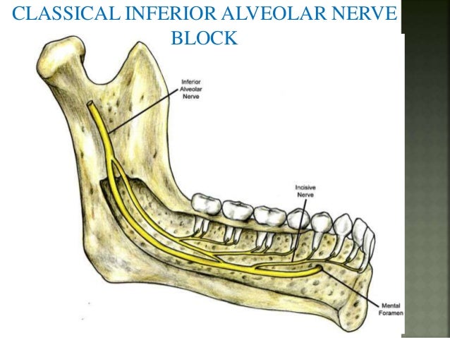 Mandibular nerve blocks techniques
