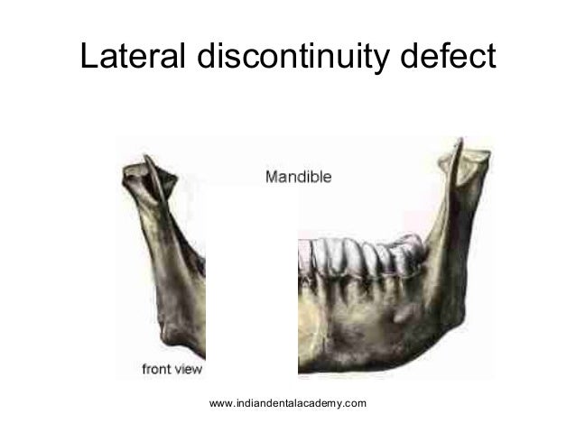 prosthodontic management of acquired defects of mandible /certified f…