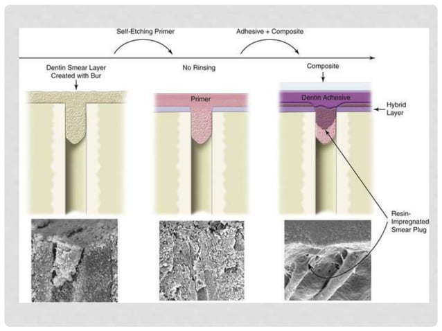 bonding to enamel & dentin | PPTX