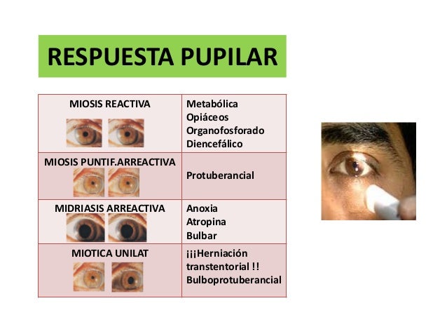 Miosis Y Midriasis