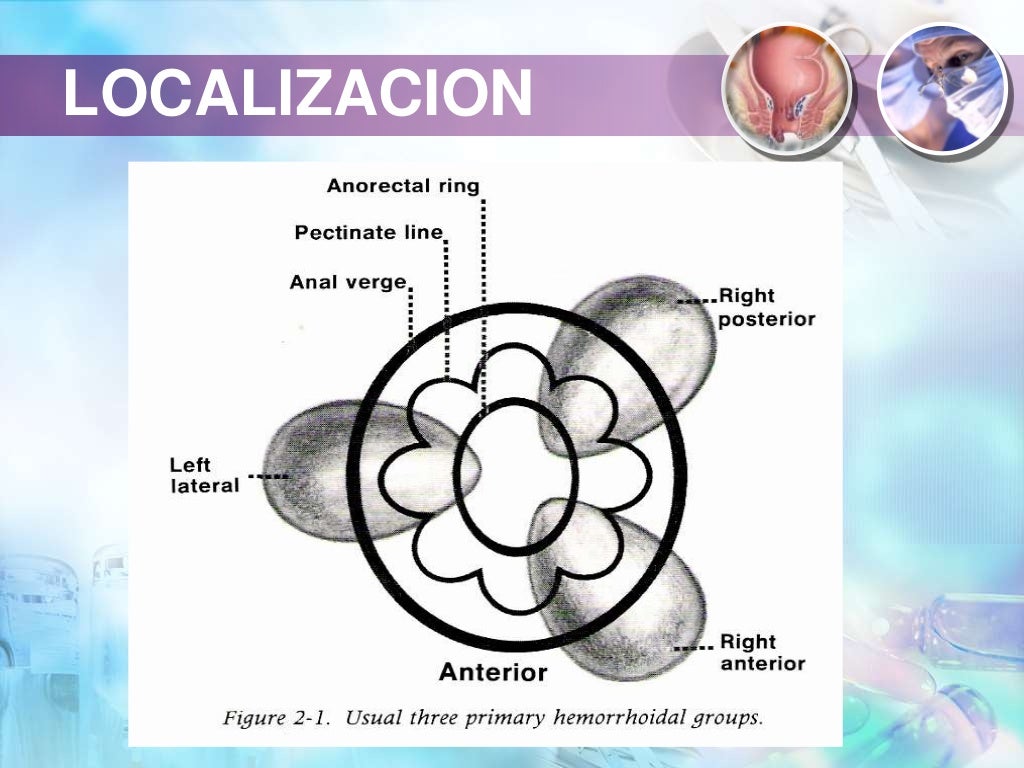 Manejo actual de la hemorroides