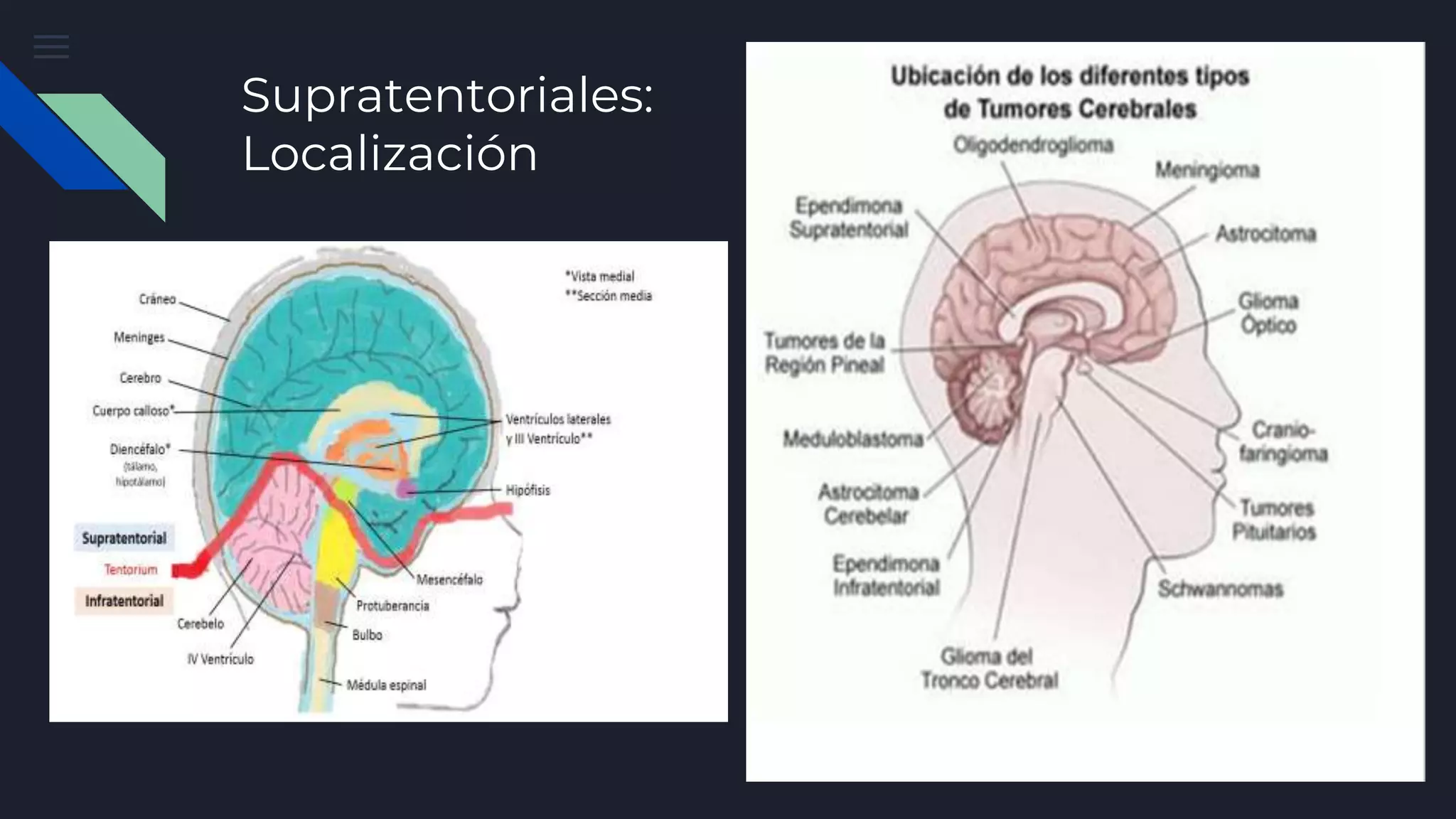 Manejo anestesico de tumores supratentoriales.pptx
