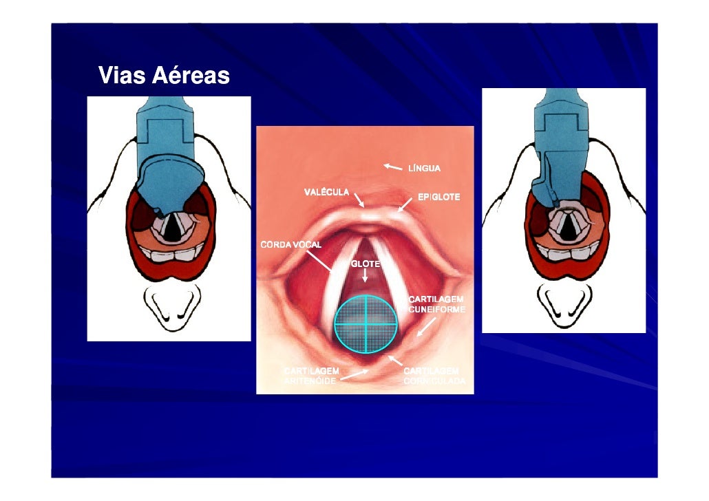 Manejo Da Via Aérea