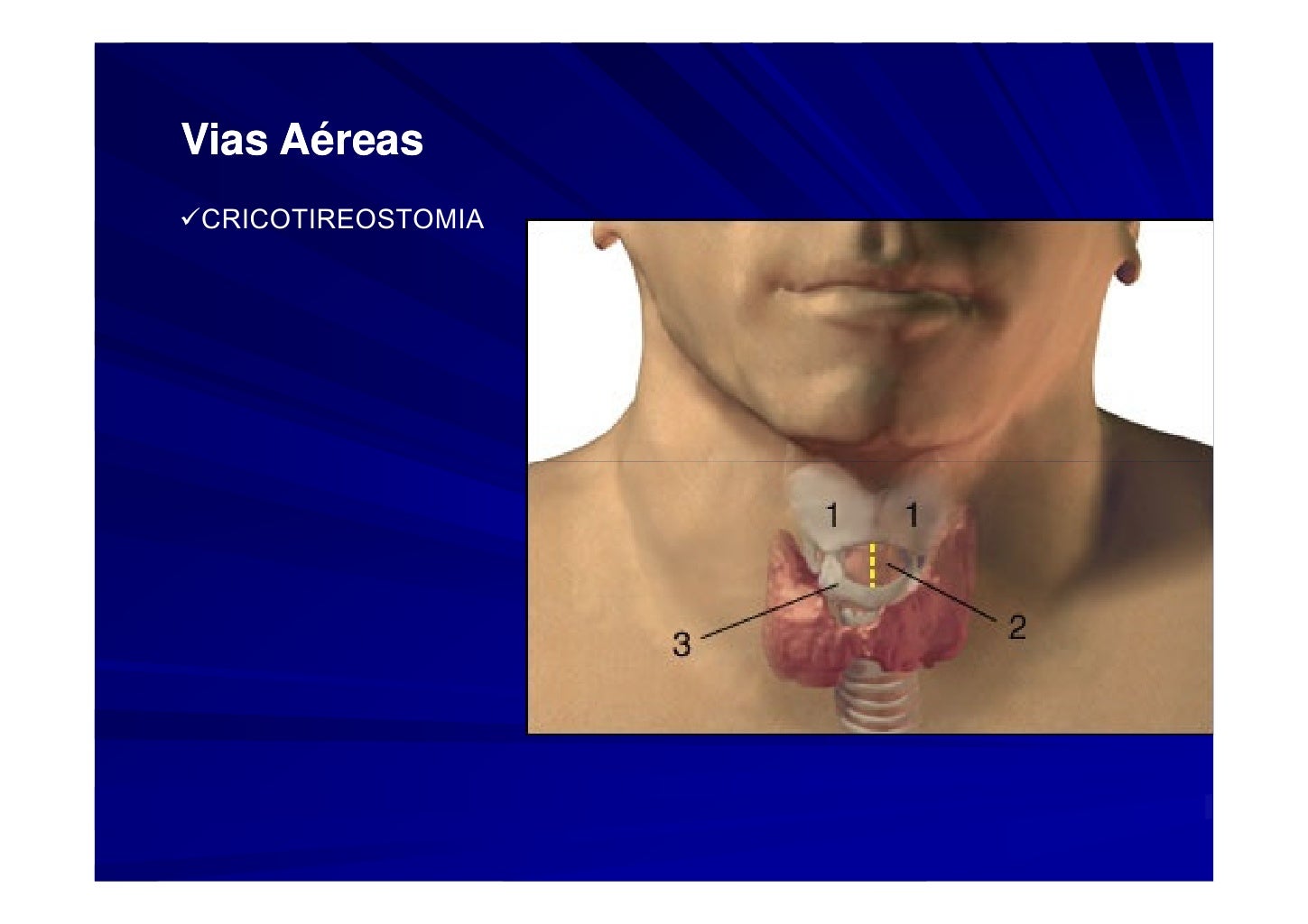 Manejo Da Via Aérea